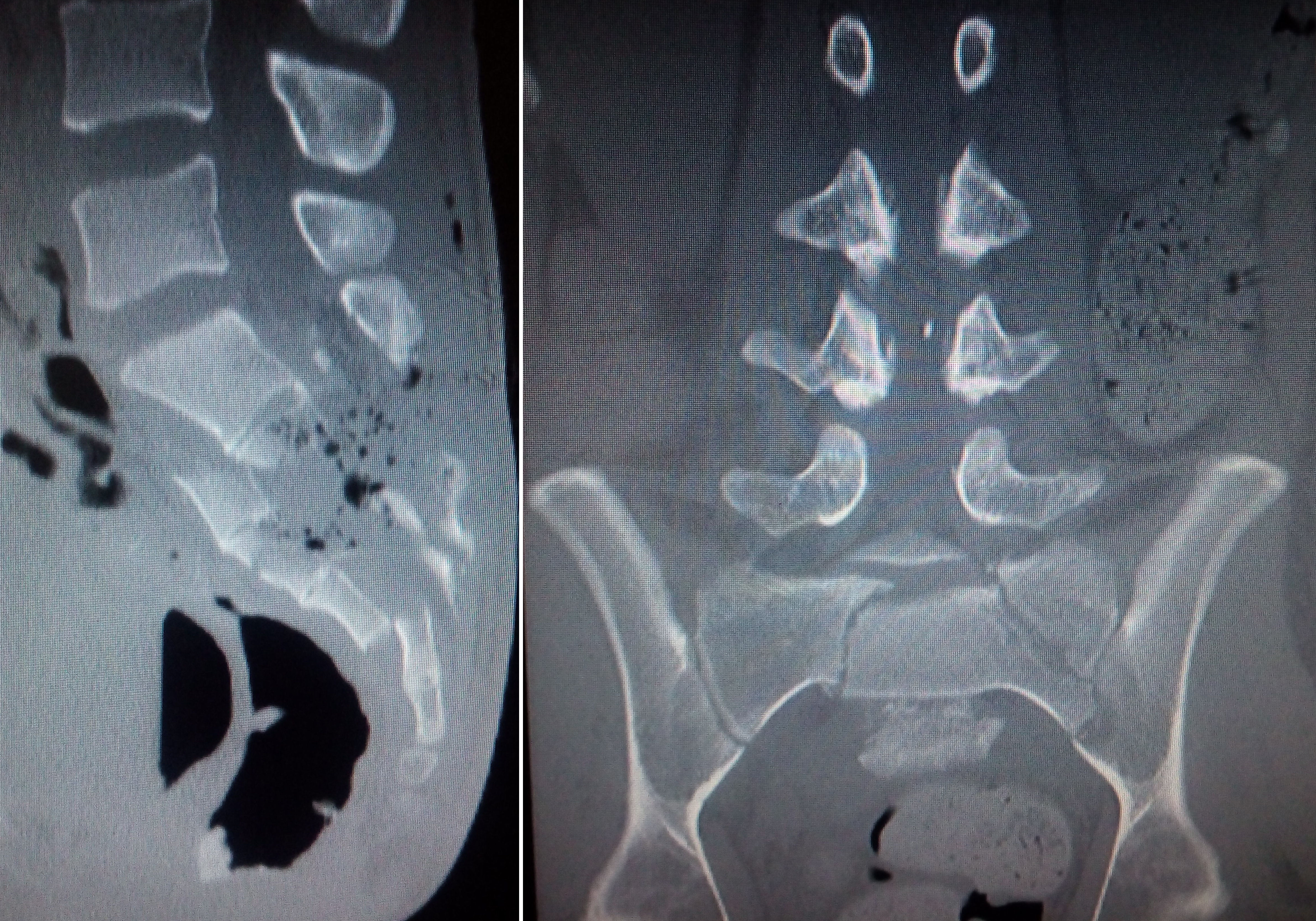 Treatment of a patient with lumbosacral and pelvic fractures due to a ...