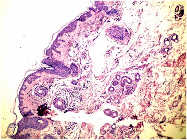 Clinical and histopathological profile of basal cell carcinomas of the ...