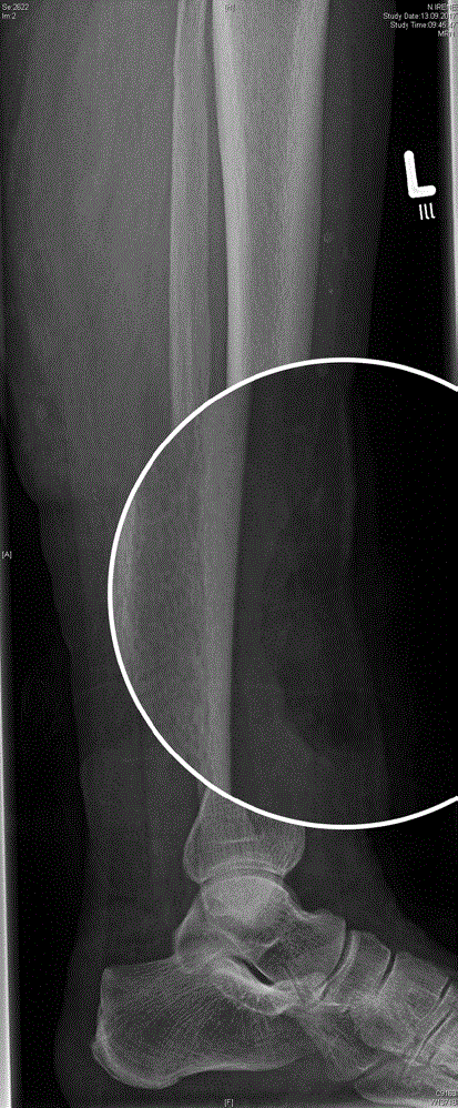 Posttraumatic panniculitis – Case series and literature review