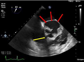 Contained Rupture of a Left Coronary Sinus of Valsalva Aneurysm: A Case ...