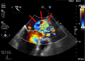 Contained Rupture of a Left Coronary Sinus of Valsalva Aneurysm: A Case ...