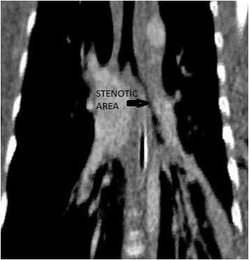 Le-Compte Maneuver in surgical correction of absent pulmonary valve ...